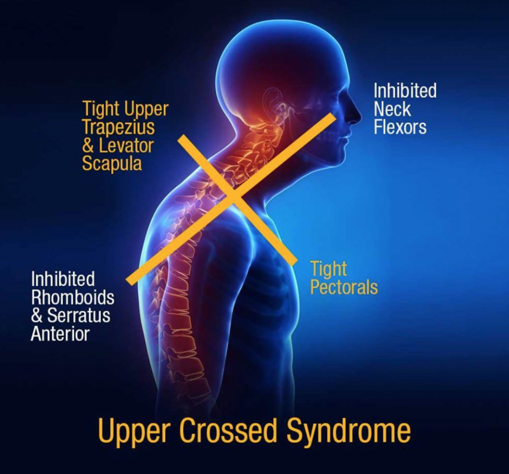 Upper Crossed Syndrome & Neck Pain - Jay Bulloch